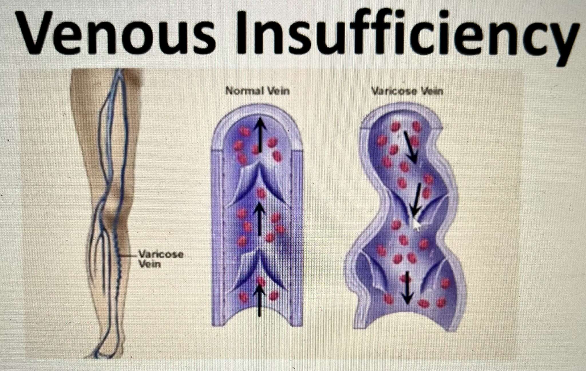 Chronic Venous Insufficiency - Complementary Therapies